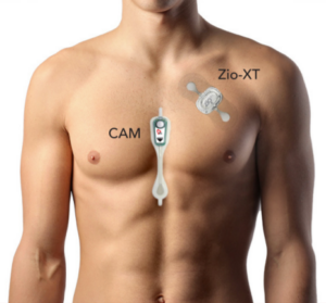 Ambulatory ECG Monitoring Solutions Made Simple | Bardy Diagnostics