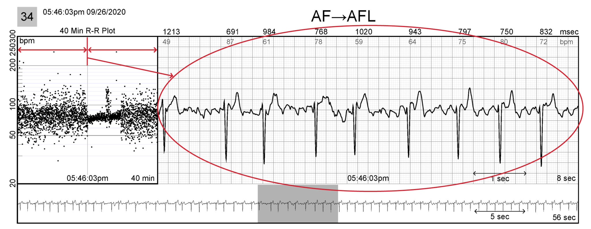 Differentiate Atrial Fibrillation from other SVTs | Bardy Diagnostics