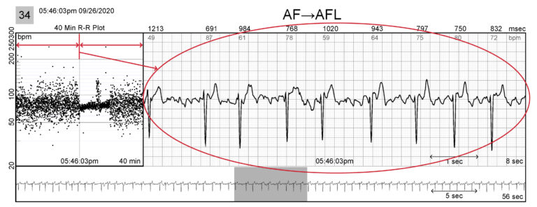 Differentiate Atrial Fibrillation from other SVTs | Bardy Diagnostics
