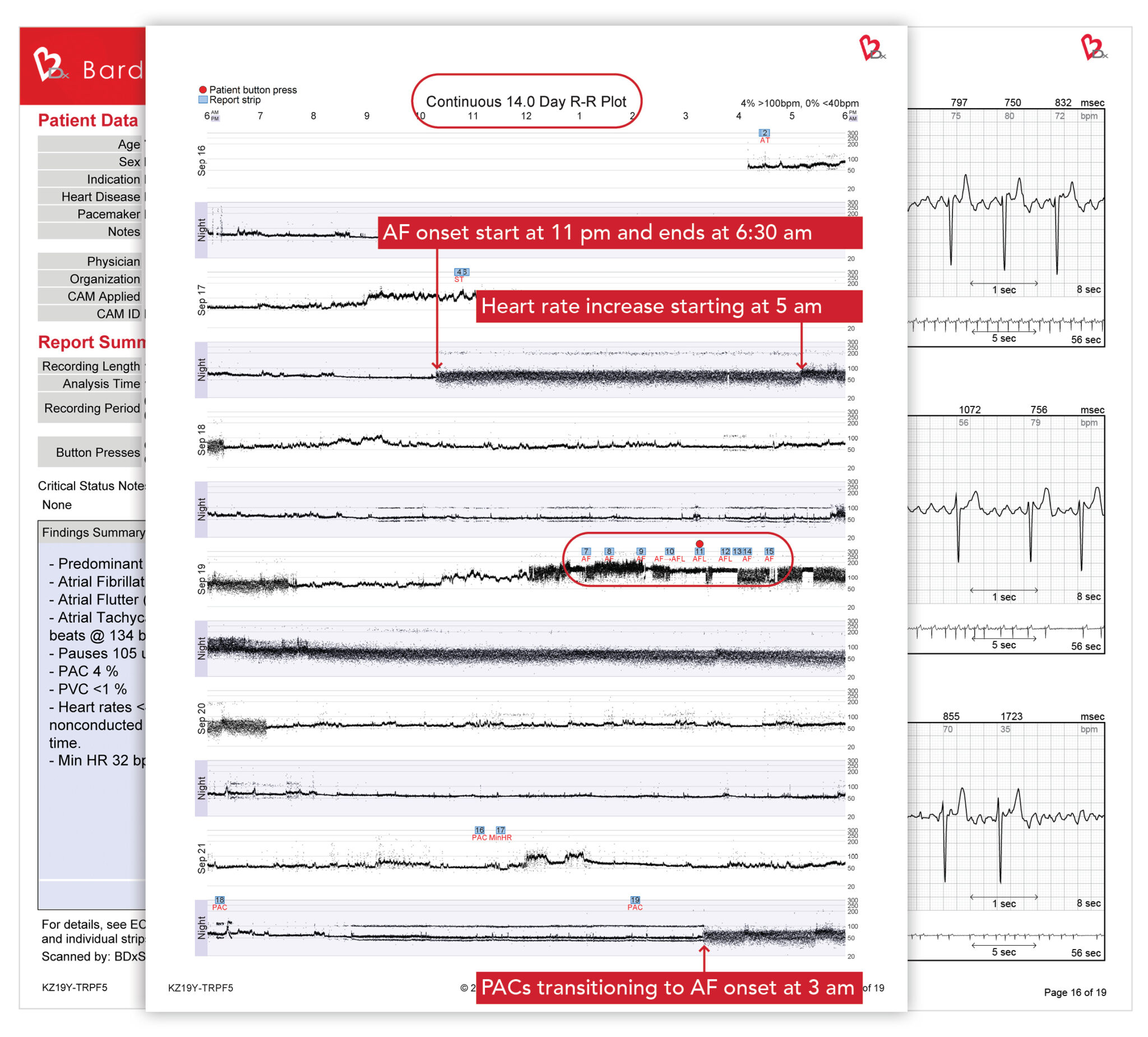 Differentiate Atrial Fibrillation from other SVTs | Bardy Diagnostics