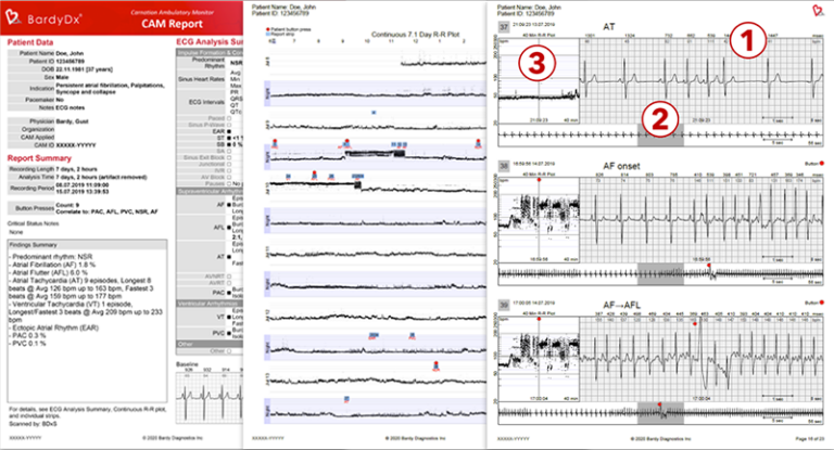 P-Wave Centric Cardiac Monitor Reporting - Interpret ECG Tracings ...