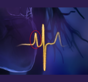 CAM Patch Clinical Studies & Evidence | Bardy Diagnostics